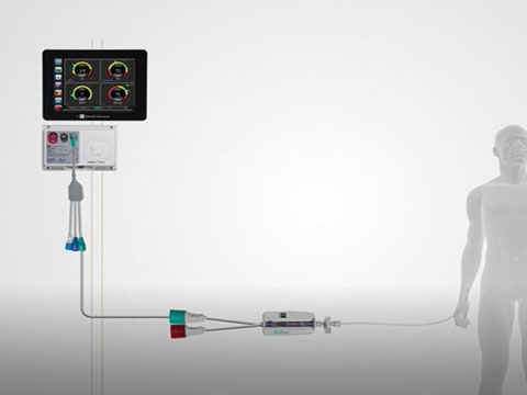 FloTrac sensor setup on EV1000 monitor