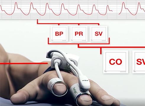 ClearSight指套式传感器概述